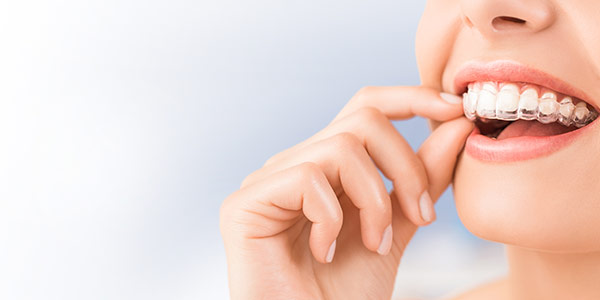 Invisalign vs. Braces Cost Near Me in Stafford TX | Smile Dental